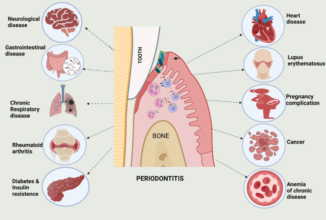 The Impact of Periodontitis on Your Overall Health